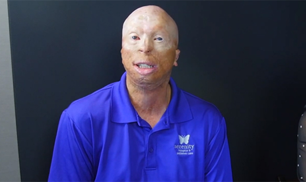 Severely burned former Phoenix police officer continues serving others